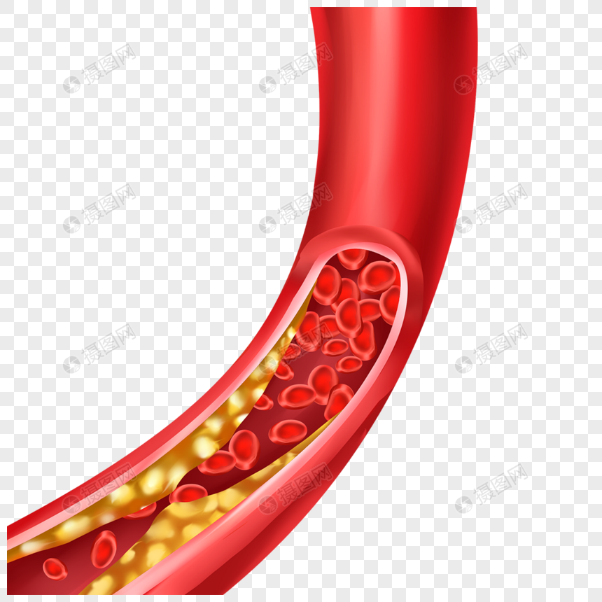 人体血管医学血管阻塞插图元素素材下载-正版素材402046865-摄图网