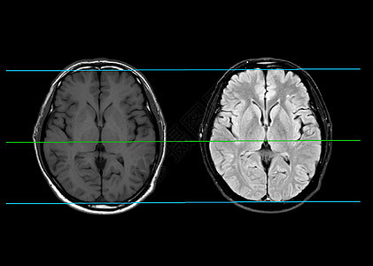 大脑的磁共振成像阿尔茨海默病的概念高清图片下载-正版图片502556526-摄图网