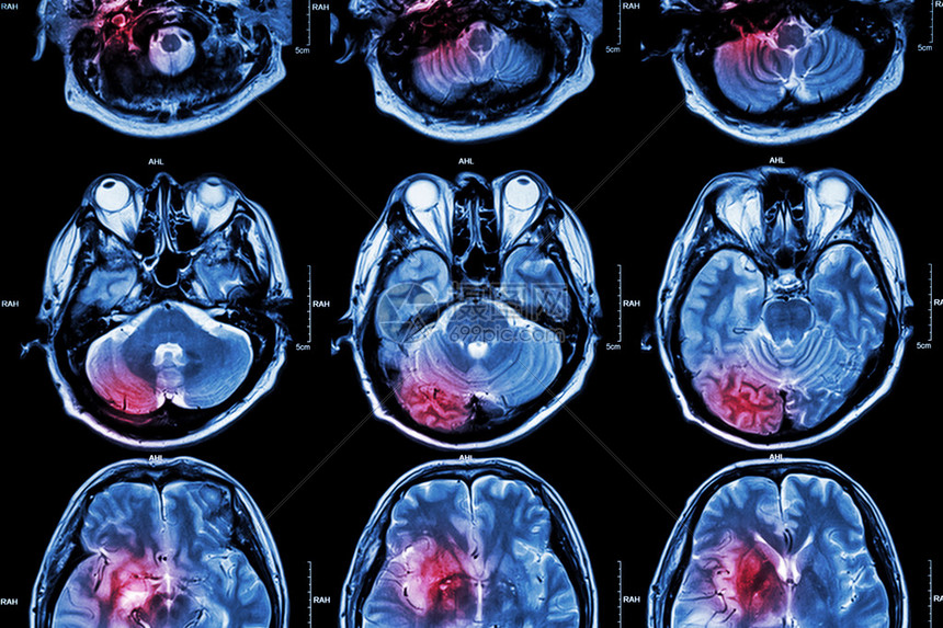 脑脑卒中脑肿瘤脑梗死脑内出血医疗保健科学背景脑交叉部分的膜MRi磁共振成像高清图片下载-正版图片502465641-摄图网