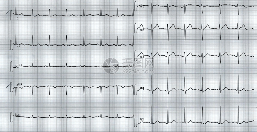 用于测量心跳的电动心电图KAEKGElektrokardig高清图片下载-正版图片502555722-摄图网