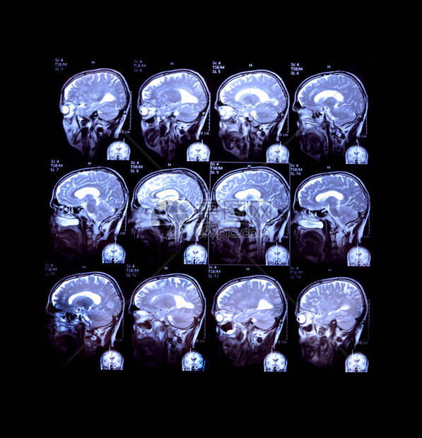 脑磁共振成像颅骨医学分析X射线MRICT高清图片下载-正版图片503698570-摄图网