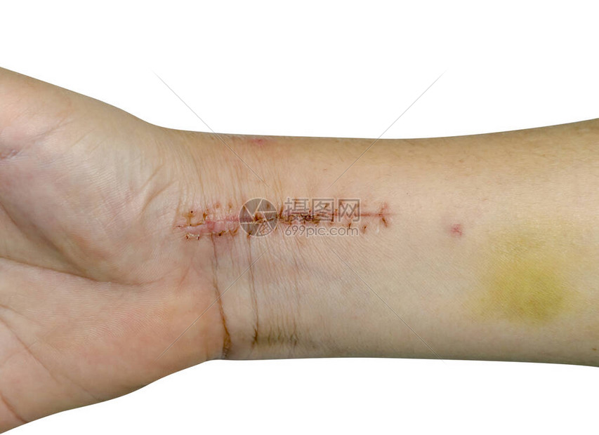 断臂手术的特写缝合和在白色背景上与剪切路高清图片下载-正版图片504125698-摄图网