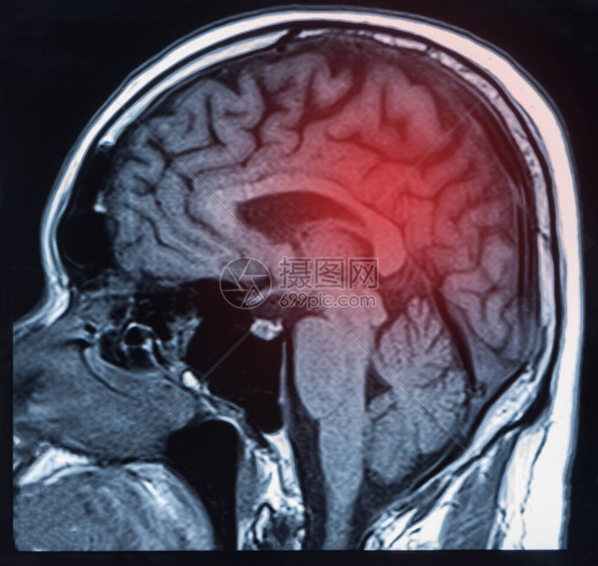 MRI扫描大脑显示结果脑ICH高清图片下载-正版图片504457061-摄图网