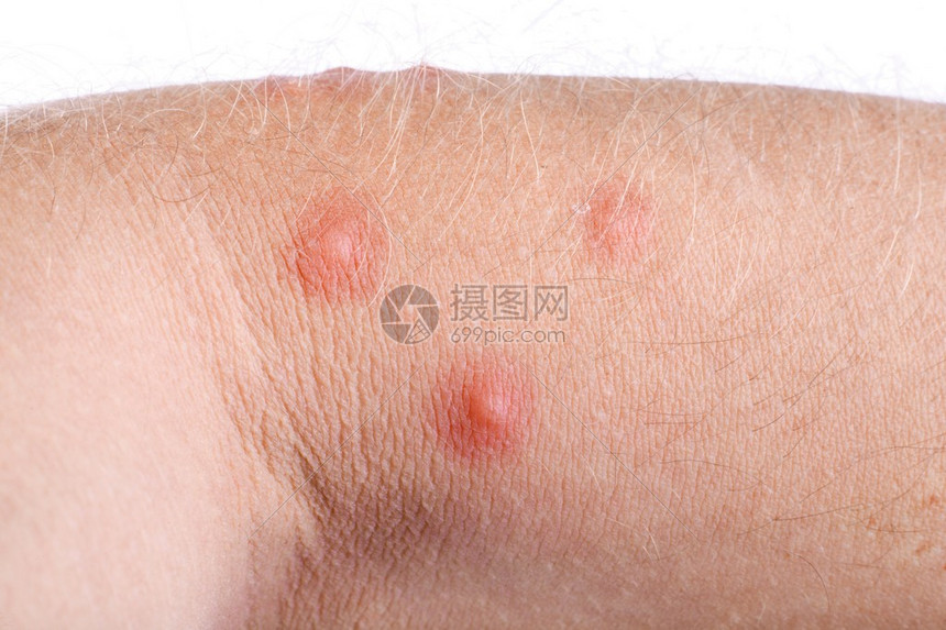 男皮肤手臂上过敏丘疹的宏高清图片下载 正版图片504731921 摄图网