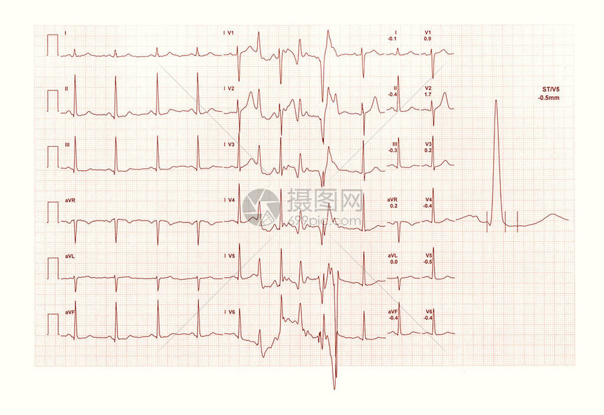 心电图ECG又名EKGElektrokardiogram高清图片下载-正版图片505006063-摄图网