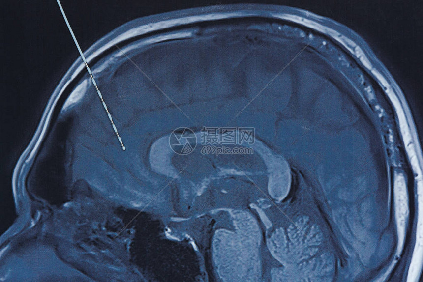 在癫痫手术中使用深度电极记录脑电波的概念脑MRI成像高清图片下载-正版图片506100501-摄图网