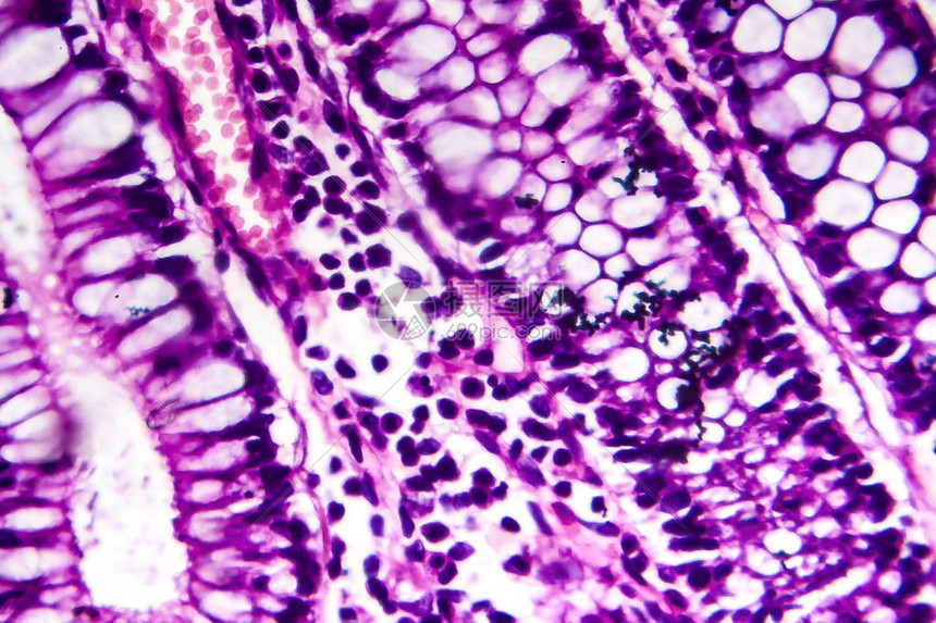 细菌痢疾光学显微照片显微镜下照片显示细菌的存在和炎高清图片下载-正版图片506152683-摄图网