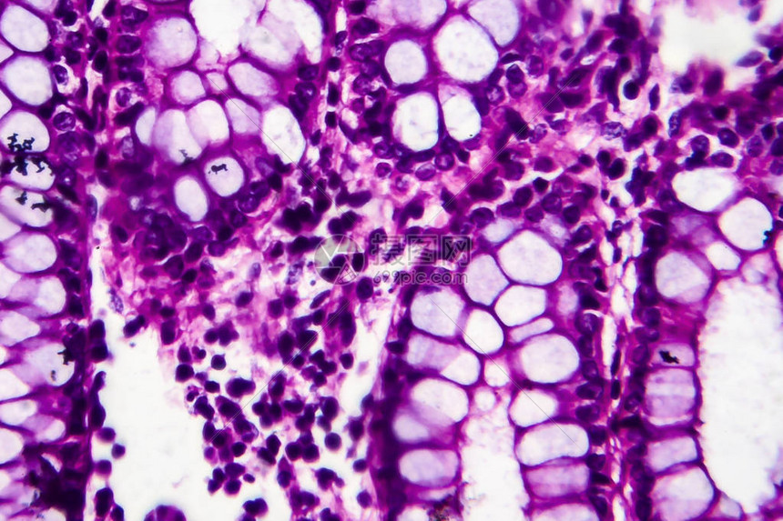 显微镜下的照片显示细菌的存在和炎症细胞的高清图片下载-正版图片506152691-摄图网