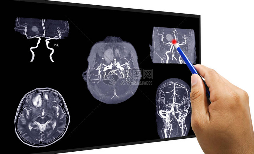 BRAIN的MRA和MRV高清图片下载-正版图片506224954-摄图网