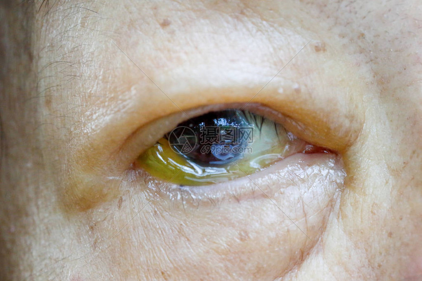 丙型肝炎CHCV的青少年高清图片下载-正版图片506295635-摄图网