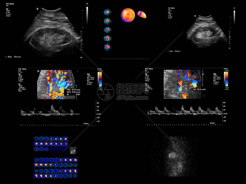 冠状计算断层摄影血管学CCTA使用注射含碘的对比度材料和CT扫描来检查向心脏提供血液的动脉高清图片下载-正版图片506439456-摄图网