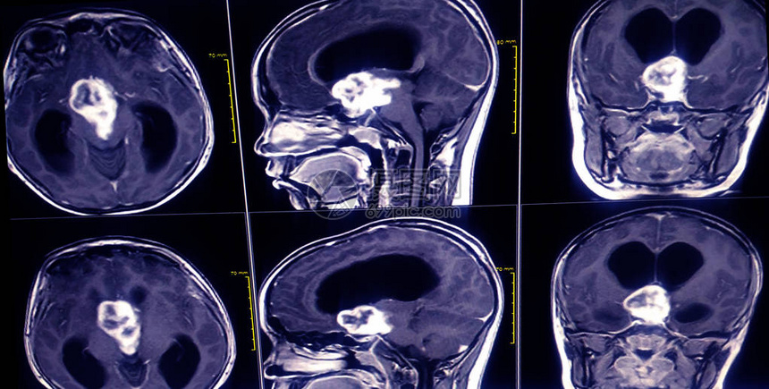 MRI脑和轨道上有一个10岁的男孩高清图片下载-正版图片507464822-摄图网